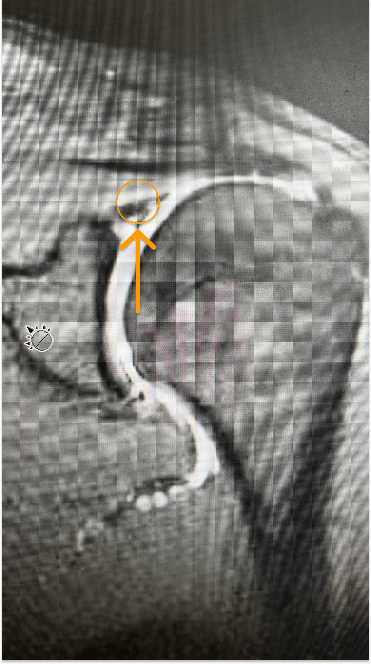 Shoulder Labrum Tears - Dr. Greg Drake