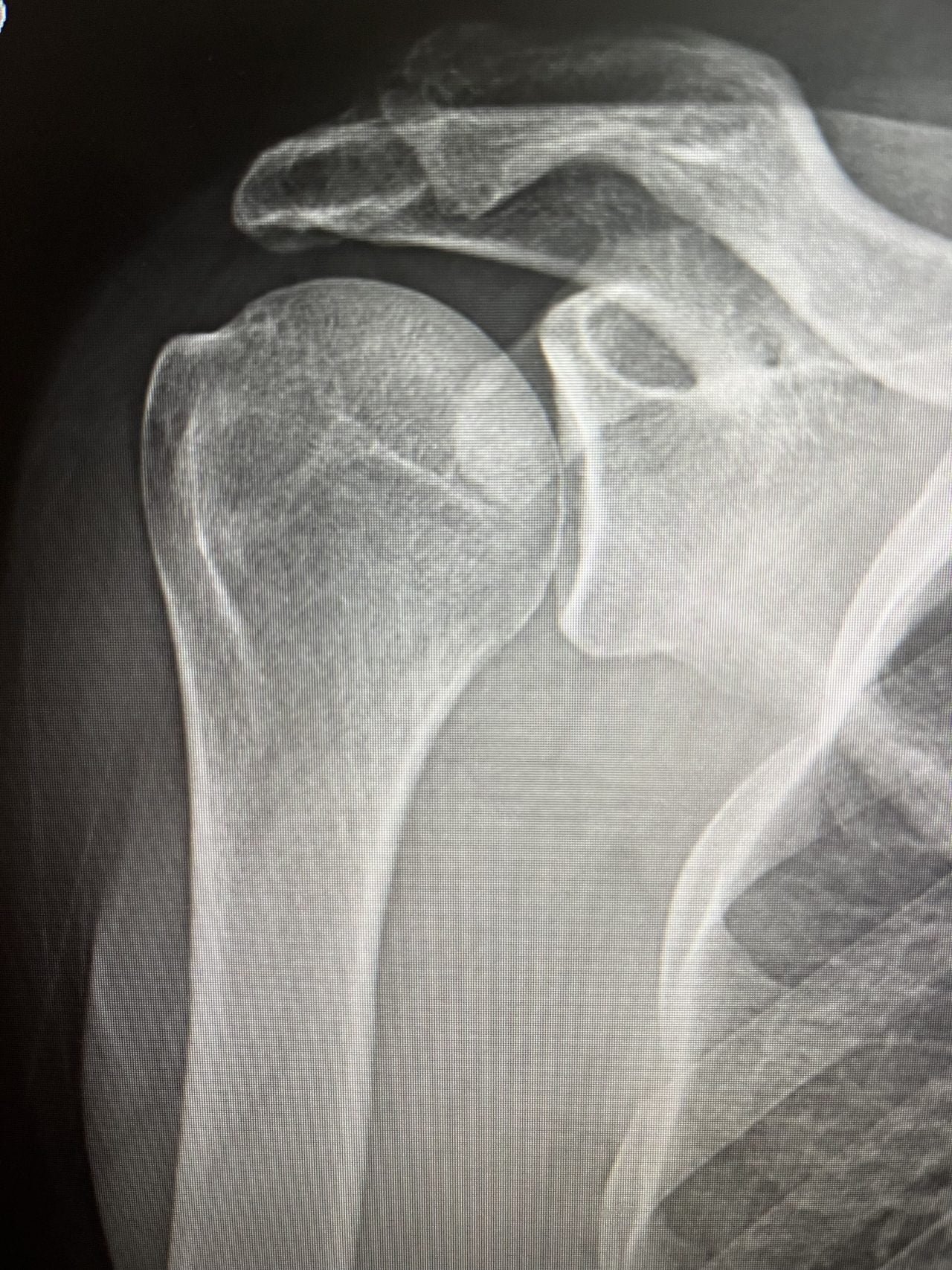 Shoulder Labrum Tears - Dr. Greg Drake