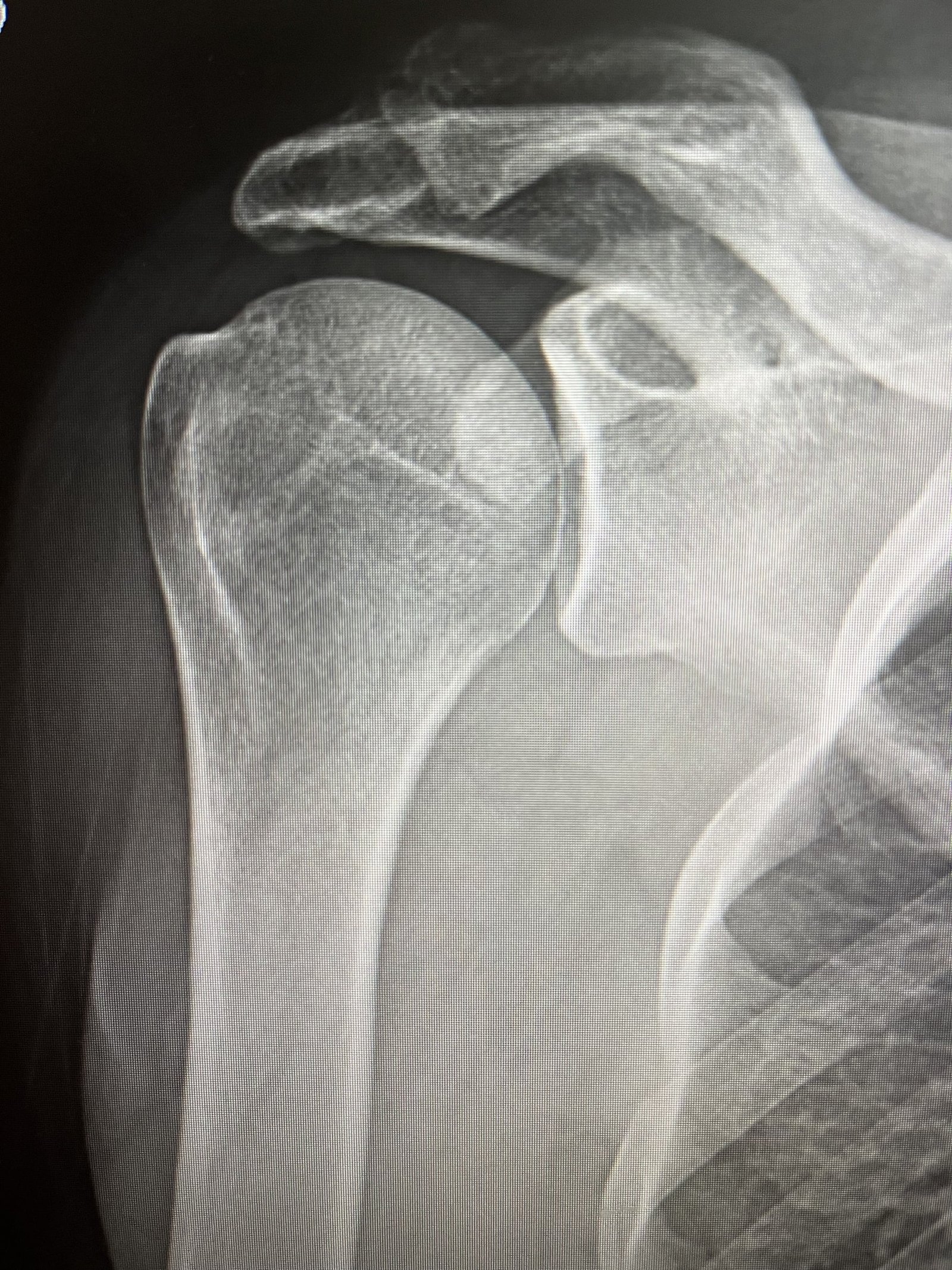 Shoulder Labrum Tears - Dr. Greg Drake