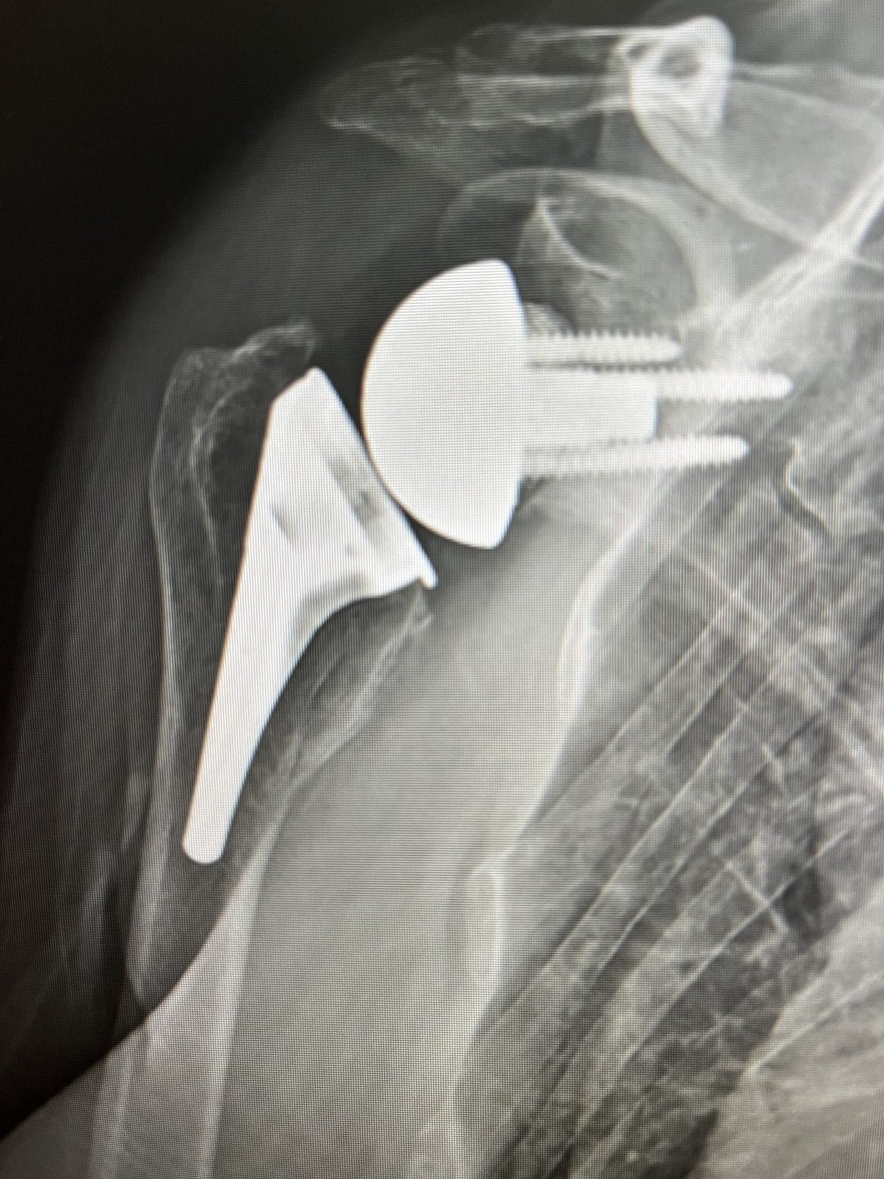 Reverse Shoulder Replacement - Level Up Shoulder