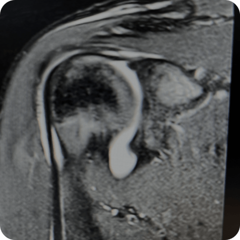 Glenoid / Shoulder Labrum Tear Surgery & Treatment in Chicago